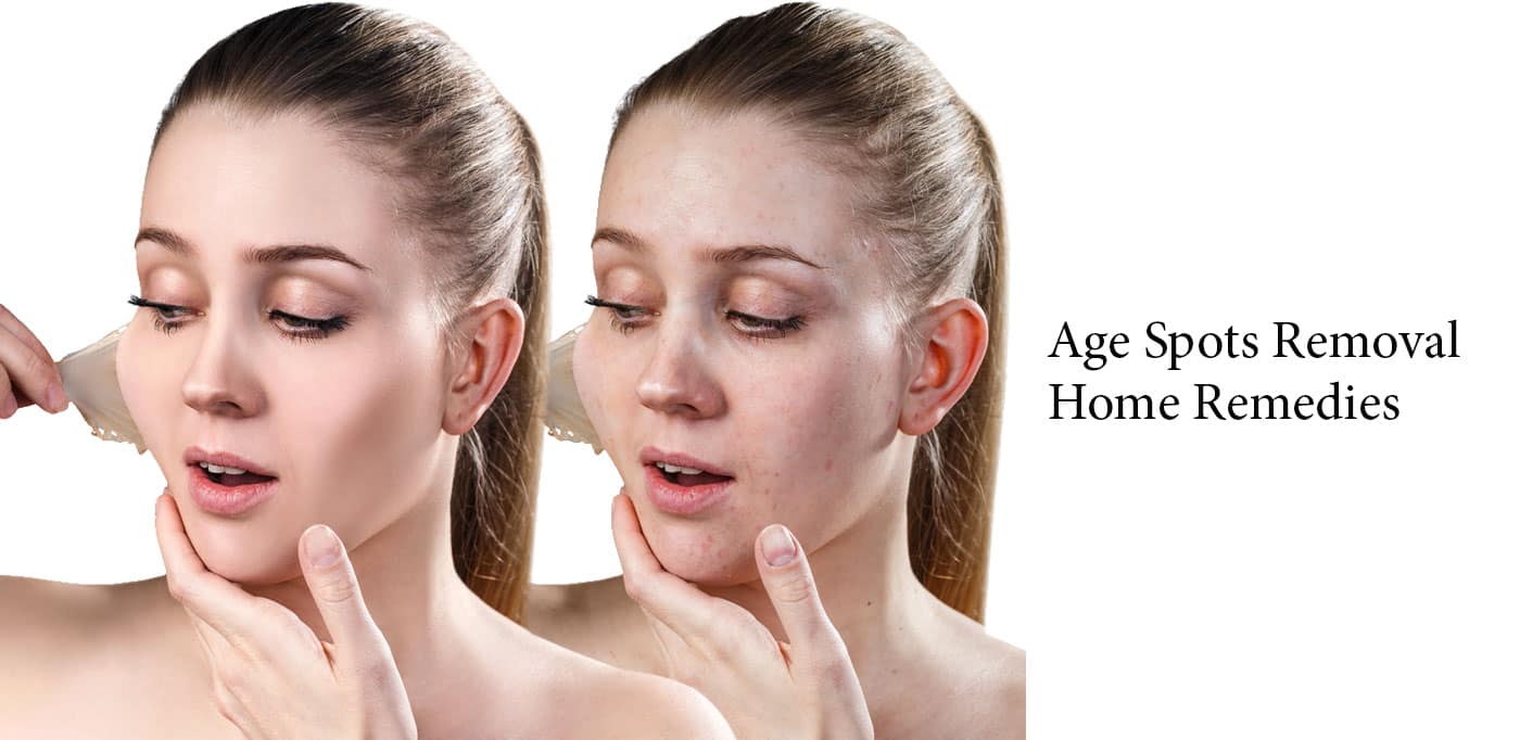 Age Spots Removal Home Remedies